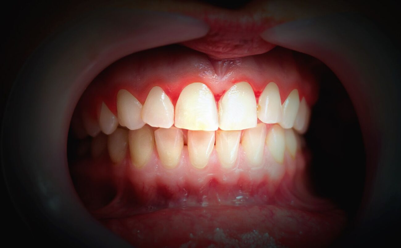 Healthy Gums Color
